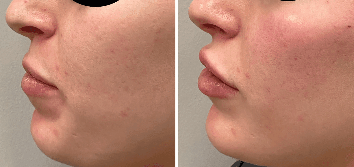 Cheek fillers you'll love to turn back the clock - Flawless Aesthetic ...